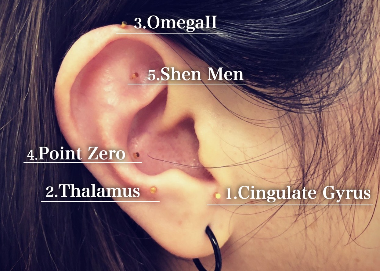 戦場鍼（BFA：Battlefield Acupuncture）とは | とよた鍼灸サロンHAL｜豊田市のクリニック併設鍼灸院